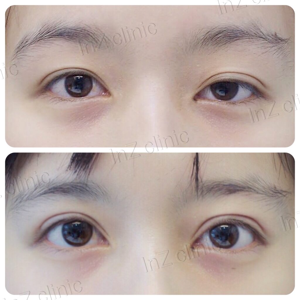 Ptosis Correction - inZ Clinic