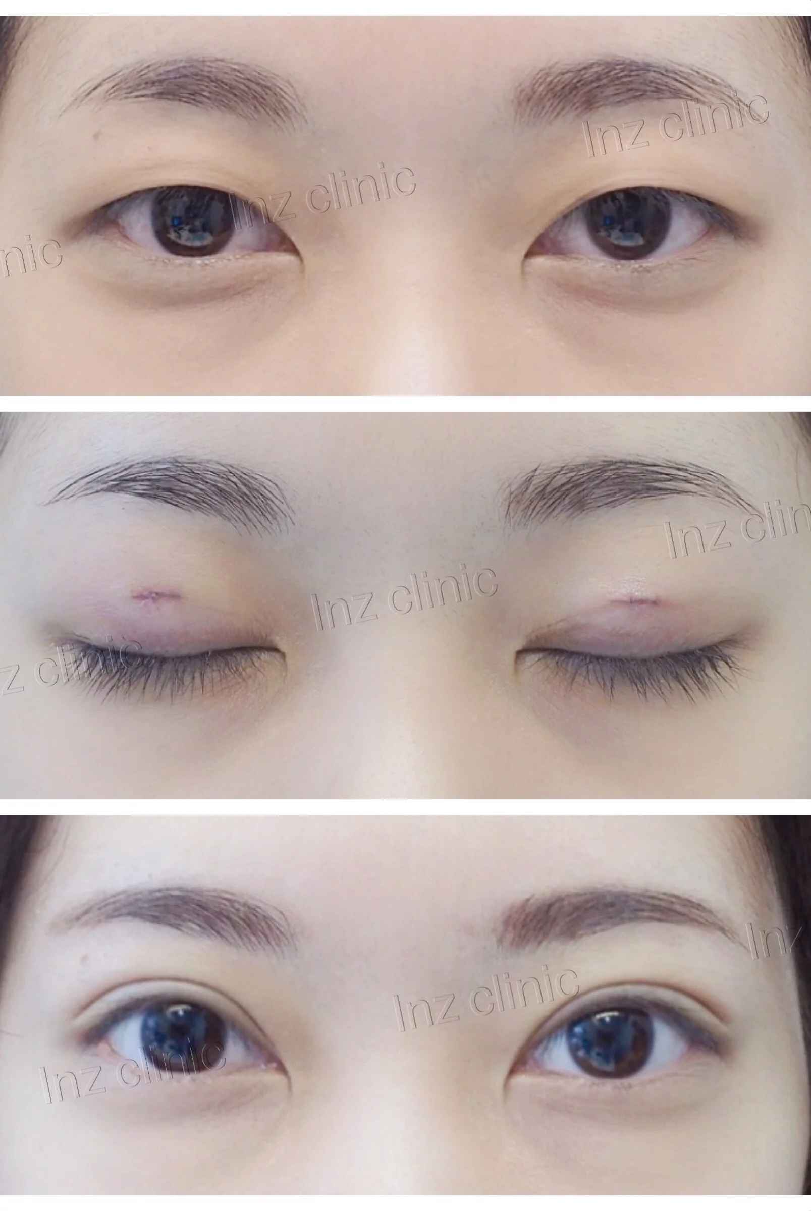 Single Eyelid Crease - inZ Clinic