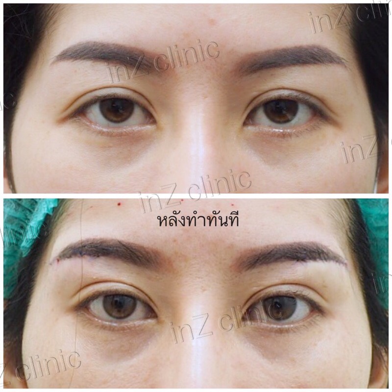 Lateral Canthopexy Review Before&After - inZ Clinic