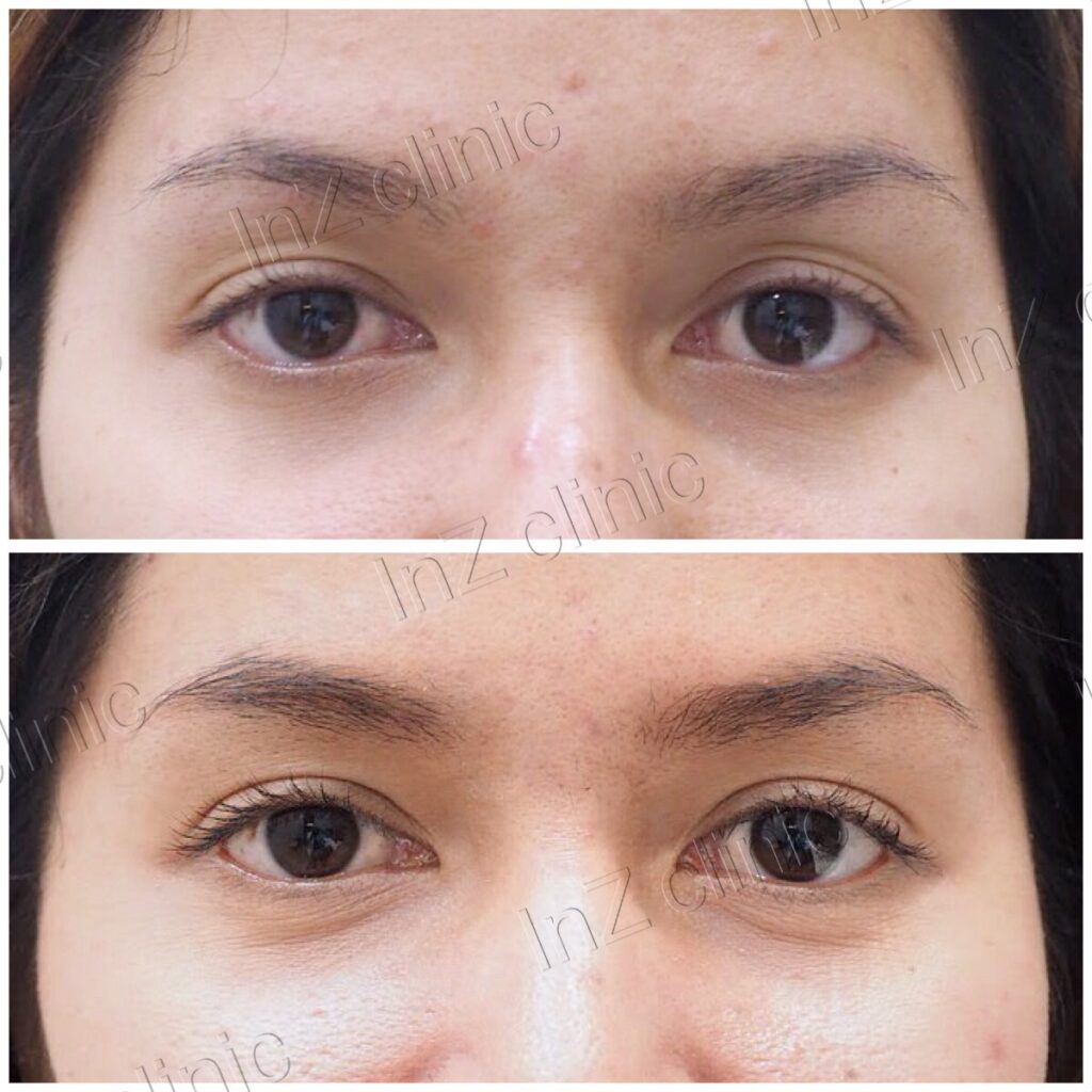 Small-Incision Blepharoplasty - inZ Clinic