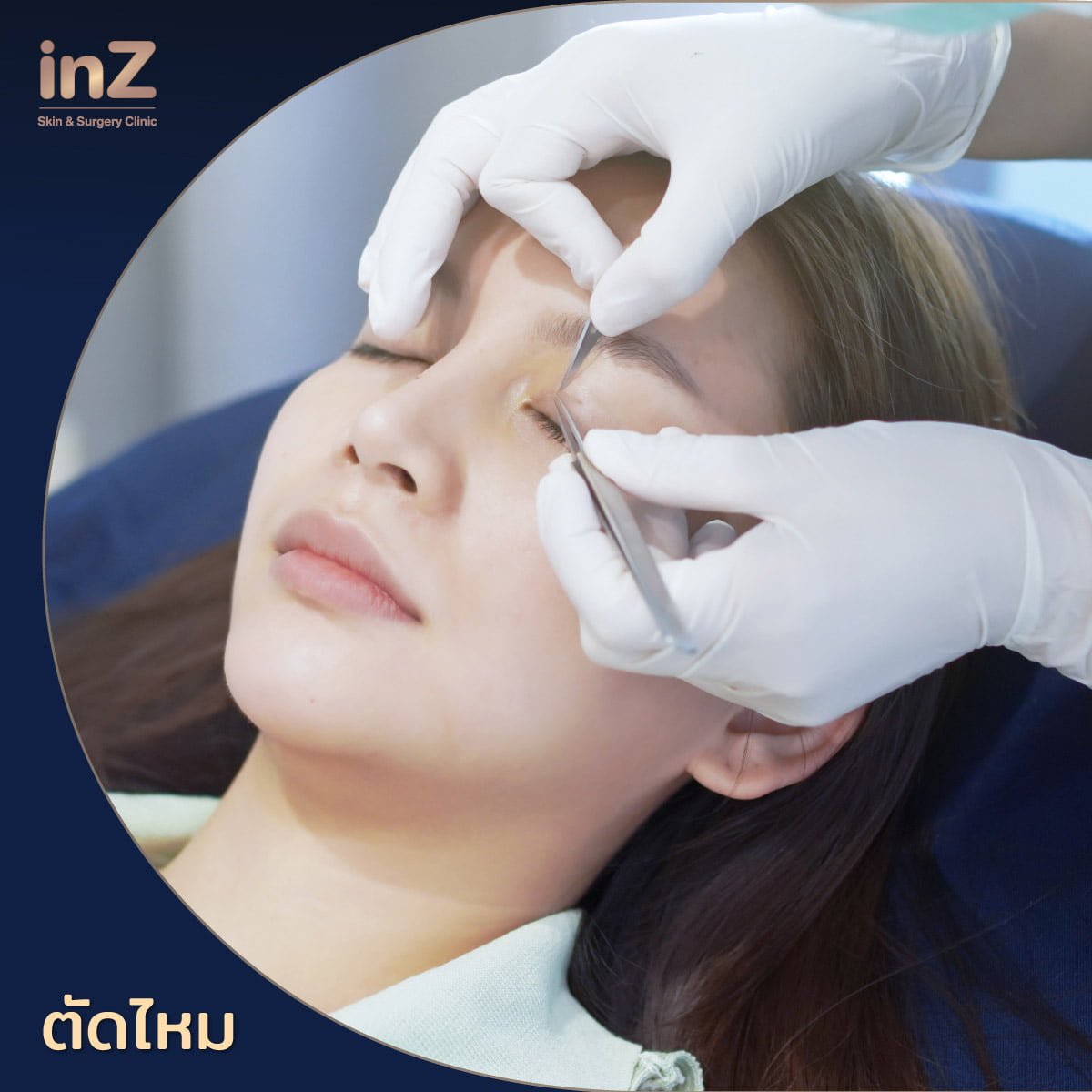 ทำตาสองชั้น ทำไมไม่ใช้ไหมละลายเย็บแผล? - inZ Clinic