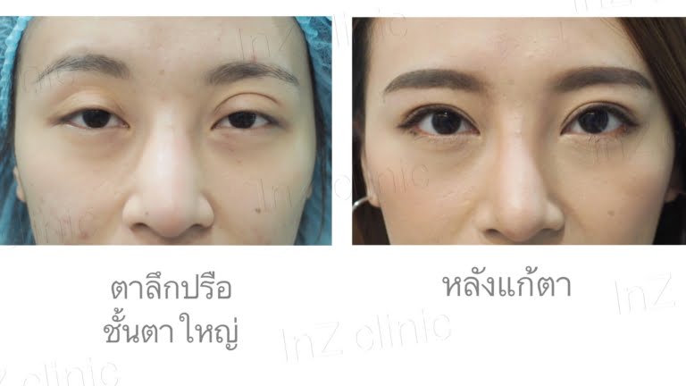Current methods of double eyelid surgery, pros & cons - inZ Clinic
