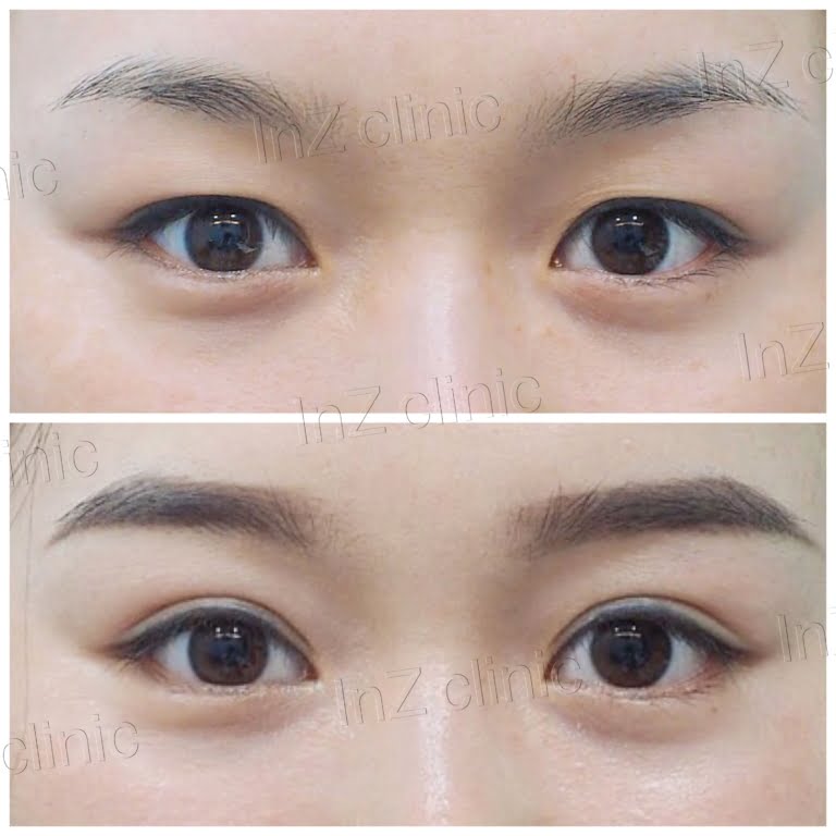 Current methods of double eyelid surgery, pros & cons - inZ Clinic