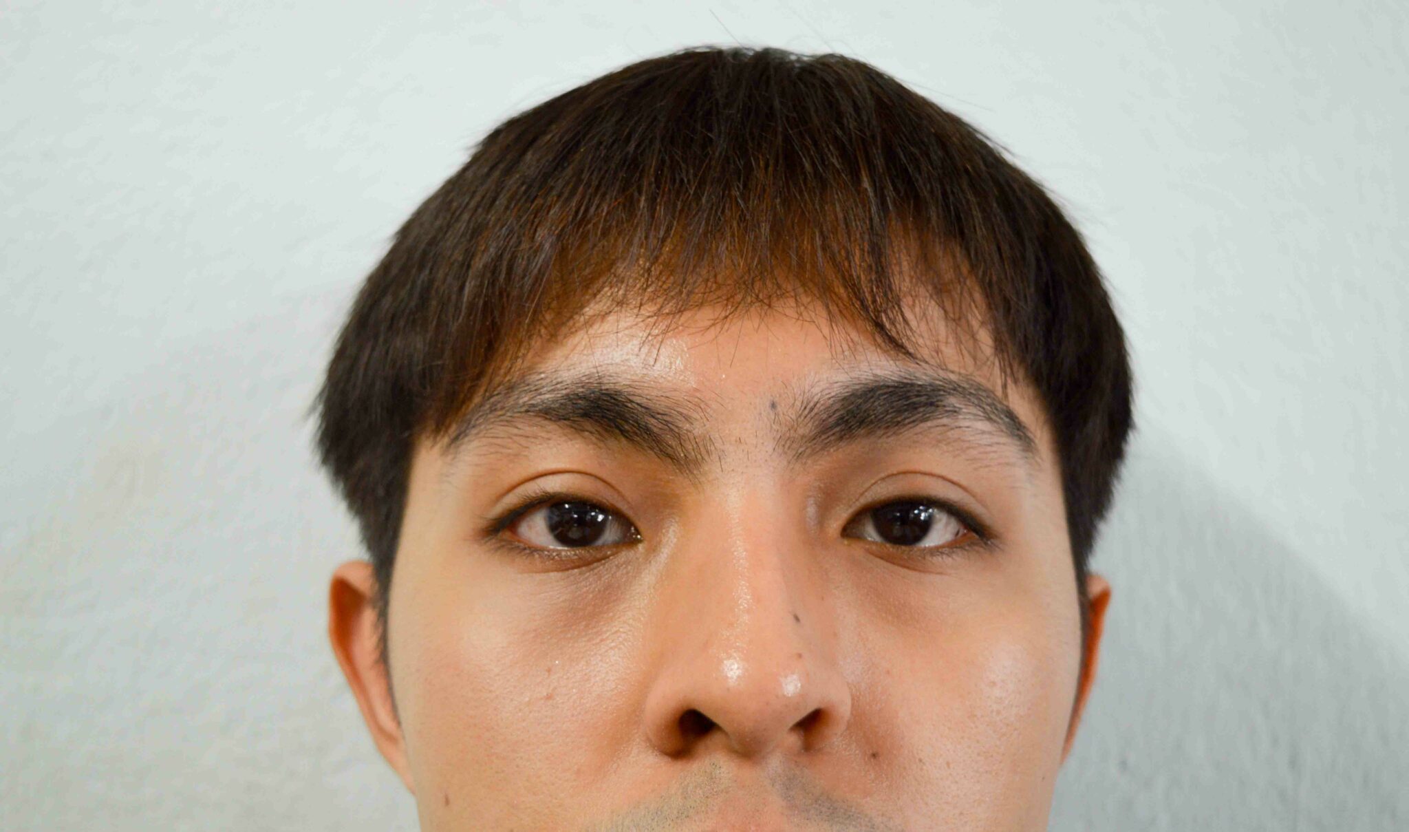 คุณมิว รีวิวทำตาสองชั้น โดยหมอหลิน - inZ Clinic