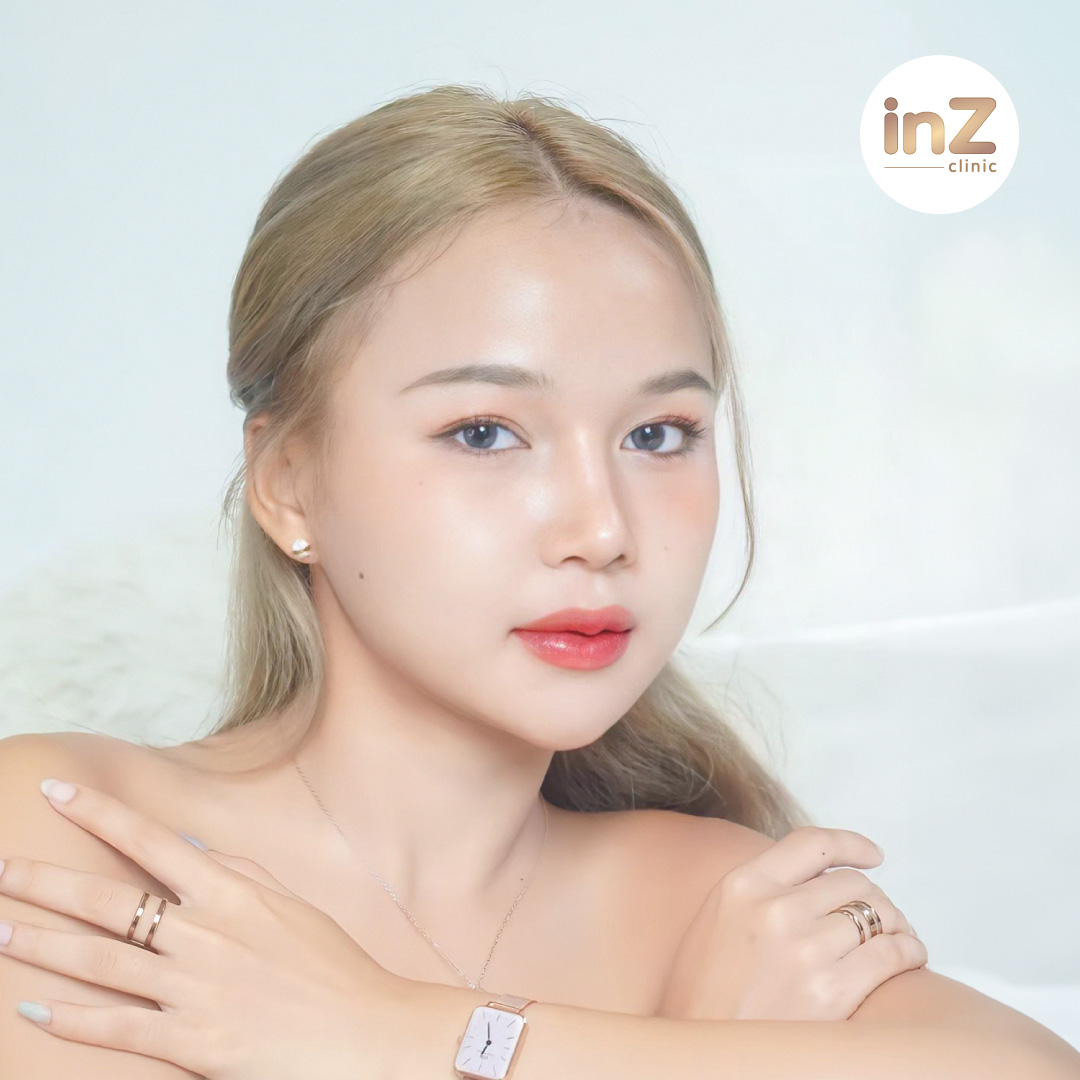 คุณสมาย รีวิวทำตาสองชั้น โดยหมอหลิน - inZ Clinic