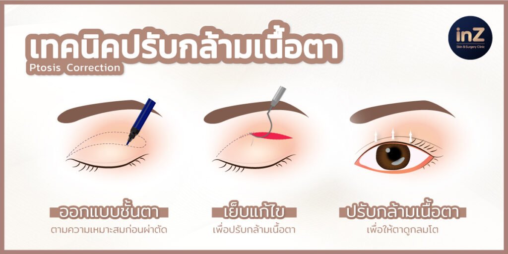 Ptosis คืออะไร ตาปรือ ตาง่วง แก้ไขได้ที่ inZ Clinic - inZ Clinic